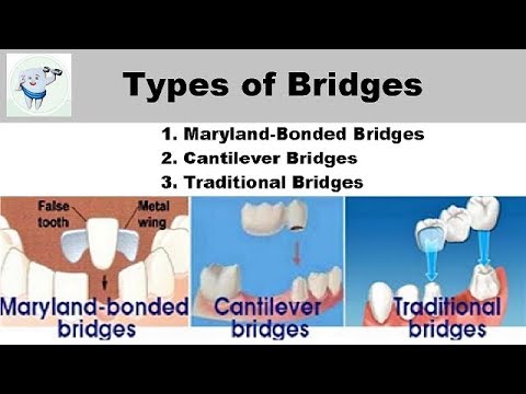 Types Of Dental Bridges