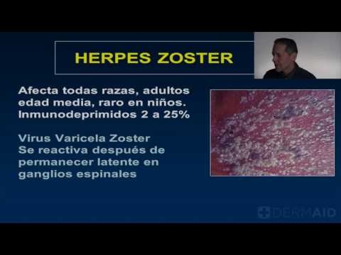 Herpes Zoster en Espanol