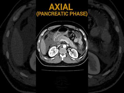 CT Scan Abdomen Contrast Enhanced to rule out Pancreatitis and any other Abdomino-Pelvic Pathology