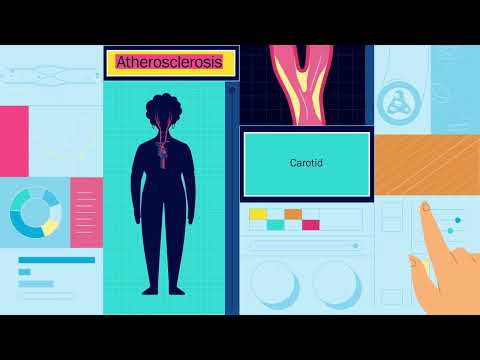 How Well Do You Know Your Heart? Part 2: Symptoms of Atherosclerosis