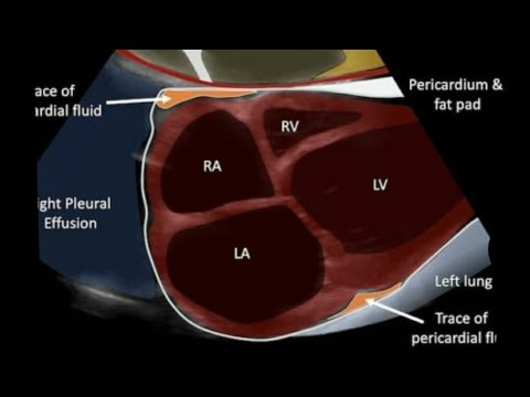 Pericardial Effusion, Ascites, Pleural Effusion.