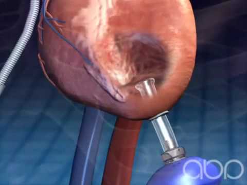 Left Ventricular Assistive Device - 3D Medical Animation || ABP ©