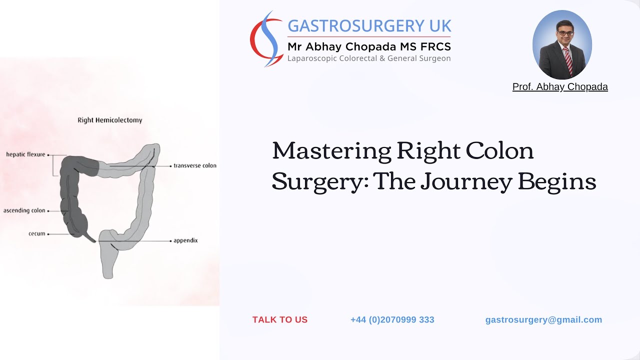 Right Hemicolectomy: Modern Surgical Approaches | Dr. Abhay Chopada | Gastrosurgery UK