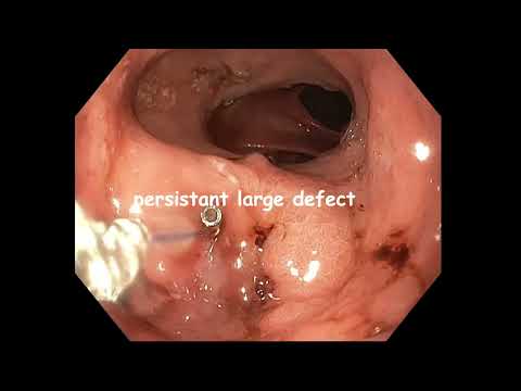 EDGE procedure -EUS-directed transgastric ERCP