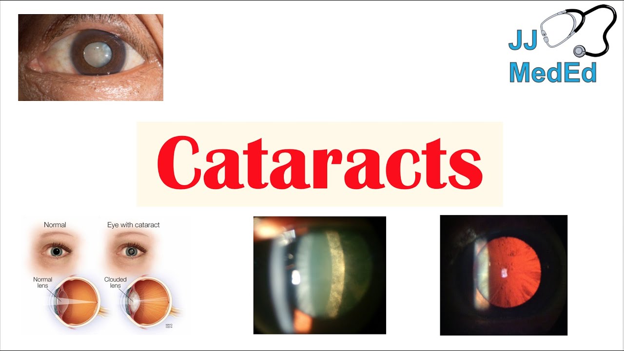 Cataracts | Causes, Risk factors, Subtypes (Cortical, Nuclear, Posterior subcapsular), Treatment