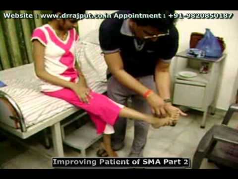 Improving Patient of SMA, Dr. Rajput Joint Replacement & Stem Cell Research Center