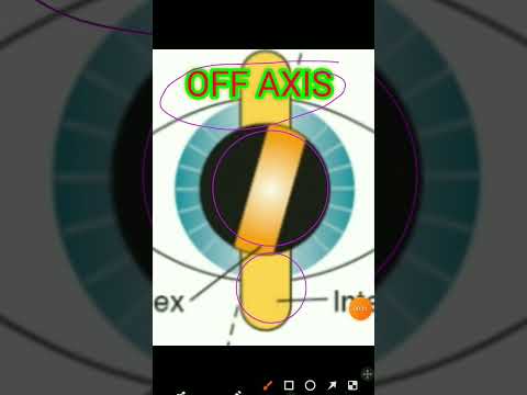 Retinoscopy intercept and reflex #eye #optometrists #diagnosis #treatments #refractive error #short