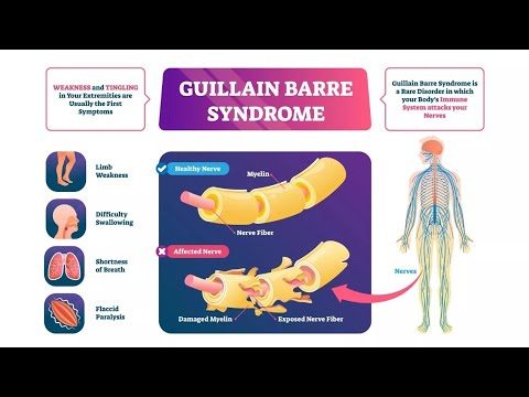 Guillain Barre Syndrome ; Definition, Causes, Symptoms, Diagnosis, Treatment