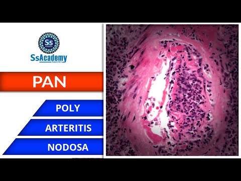MRCP Part 1 Preparation | PolyArteritis Nodosa (PAN)