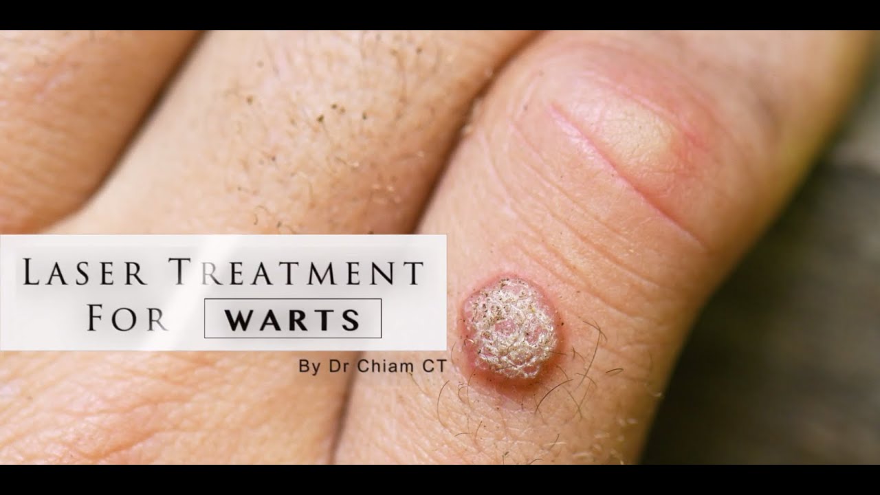 Warts removal with Laser Treatment | Dr. Chiam CT