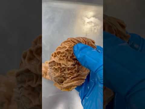 Stomach Ulcers