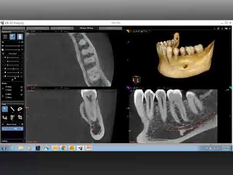 CS 3D Imaging- Review of Mandible