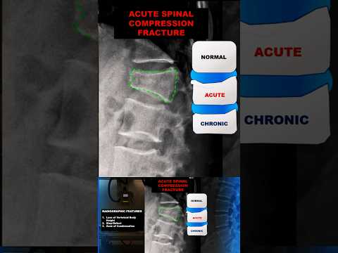 Spinal compression fracture on X-ray #shorts #radiology #doctor #health