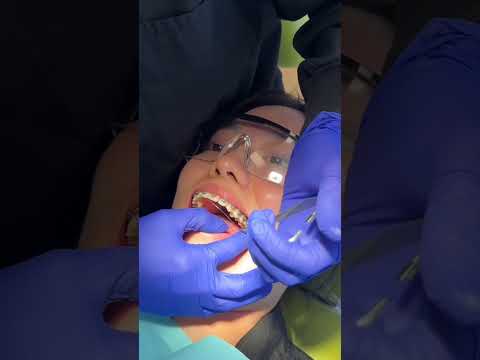 Orthodontist rating registered dental assistant’s skills #braces #smile #bracesjourney #braceslife
