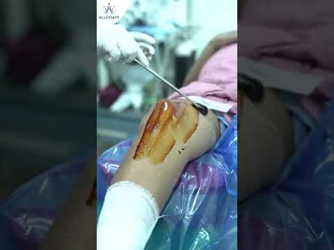 Non Surgical Treatment for Chronic Knee Pain - Genicular Nerve Rhizotomy