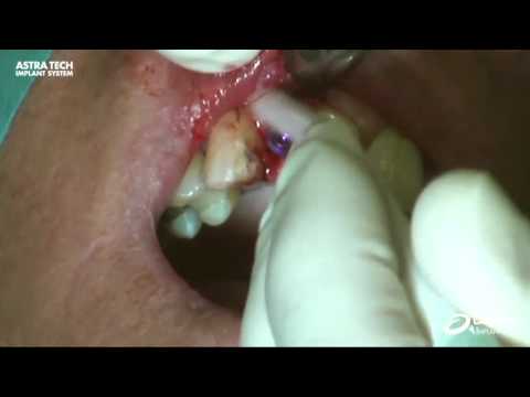HealDesign™ EV Triangular – Installation | Dentsply Sirona