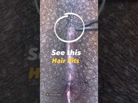 See Live - Hair Removal - Pilonidal Sinus ? What is Pilonidal sinus Cyst ? Hair removal from Pits ?