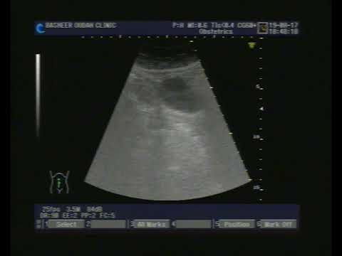 atherosclerosis of the abdominal aorta without aneurysm 1