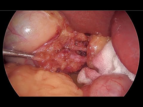 LiVac™️ Retraction for obese cholecystectomy