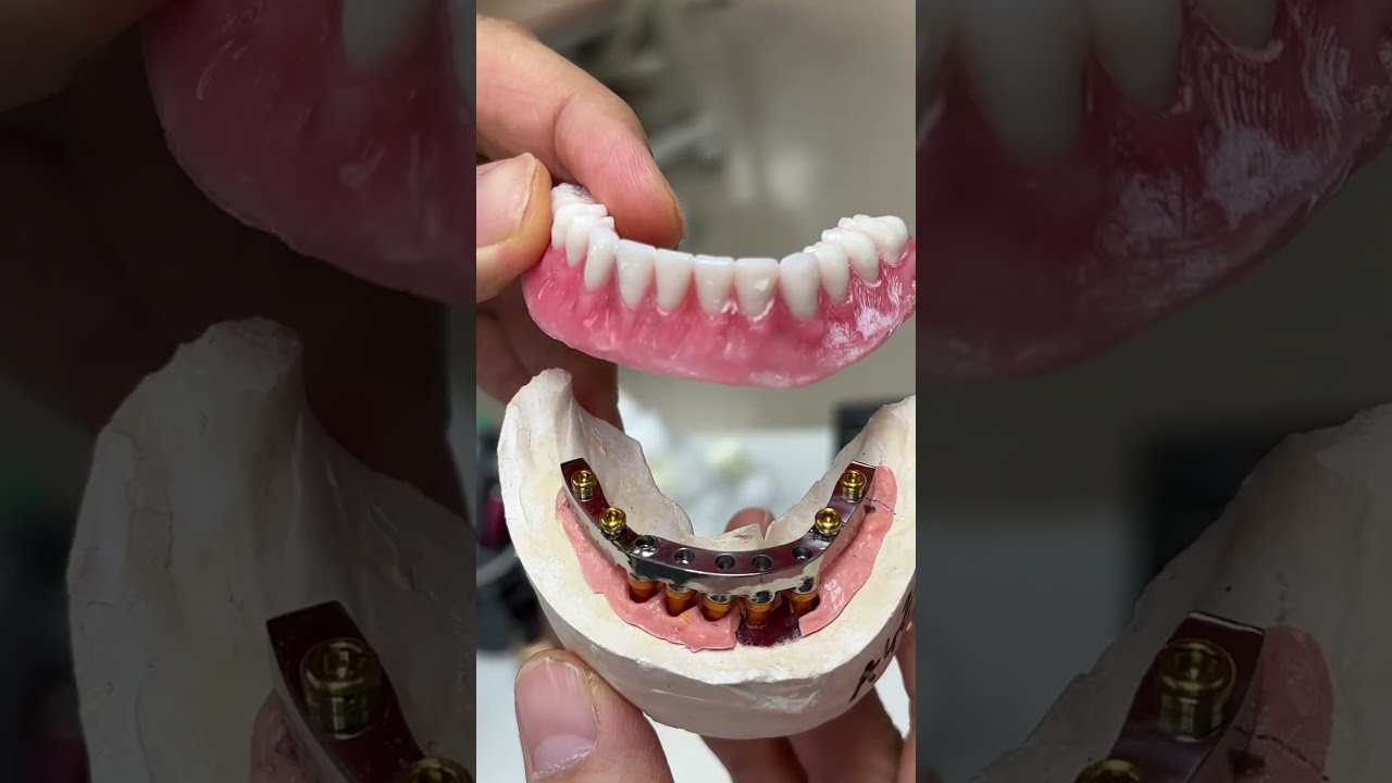 Fancy Removable Overdenture case! @ZestDentalSolutions
