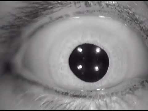 Nystagmus from right posterior canal BPPV