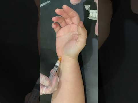 Right Carpal Tunnel Steroid Injection