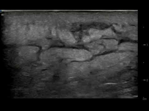 Video 1. Cellulitis