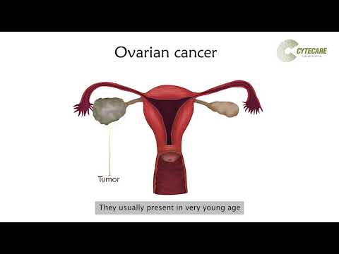 Ovarian Cancer Insights: Symptoms And Diagnosis | #OvarianCancer | Cytecare Cancer Hospital