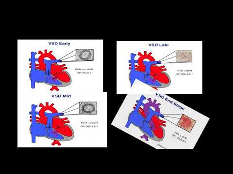 EISENMENGER SYNDROME