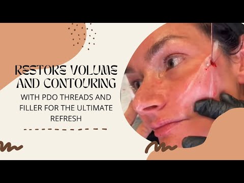 RESTORE VOLUME AND CONTOURING WITH PDO THREADS AND FILLER FOR THE ULTIMATE REFRESH | Dr. Jason Emer