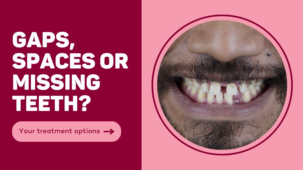 Gaps, Spaces or Missing Teeth? - MUST SEE Smile Makeovers!