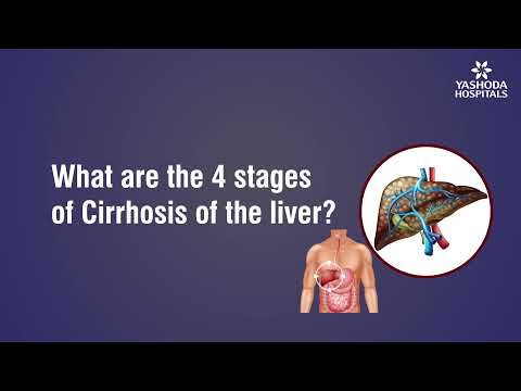 What are the 4 stages of Cirrhosis of the liver?