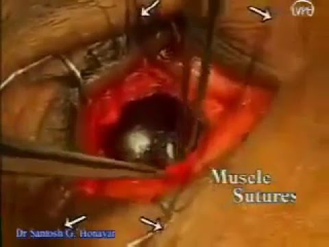 Surgery To Removal Of Eyeball And Implantation Of Artificial Eyeball