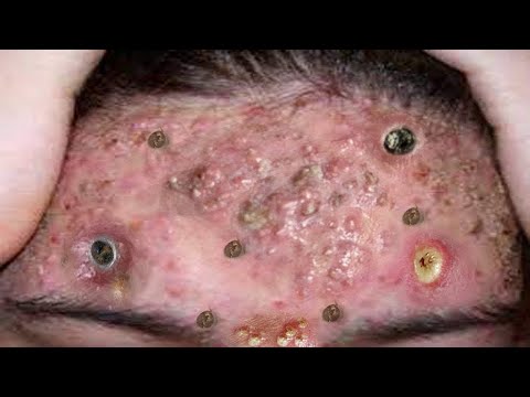 Big Cystic Acne Blackheads Extraction Blackheads & Milia, Whiteheads Removal Pimple Popping #5558