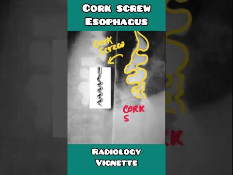 Cork screw Esophagus in Diffused Esophagial spasm: radiology made simple for USMLE, NEET PG, NCLEX
