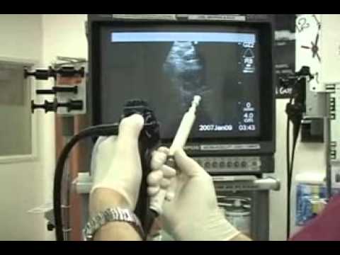 Endobronchial Ultrasound (EBUS) Biopsy of Mediastinal Lymph Nodes 1