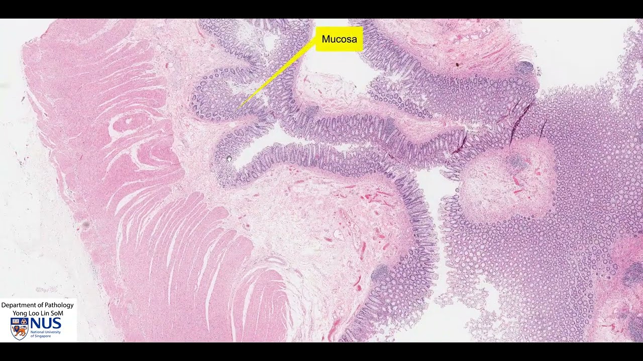 Colon diverticulum microscopy: Talking slide