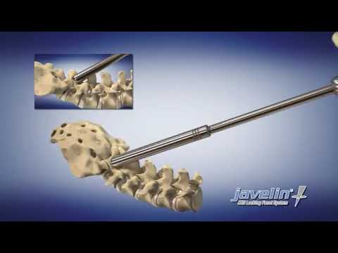 CTL Amedica: Javelin MIS Locking Facet System
