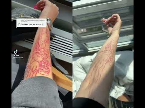 Results of removing red ink tattoo 3 years after , each session 8 week
