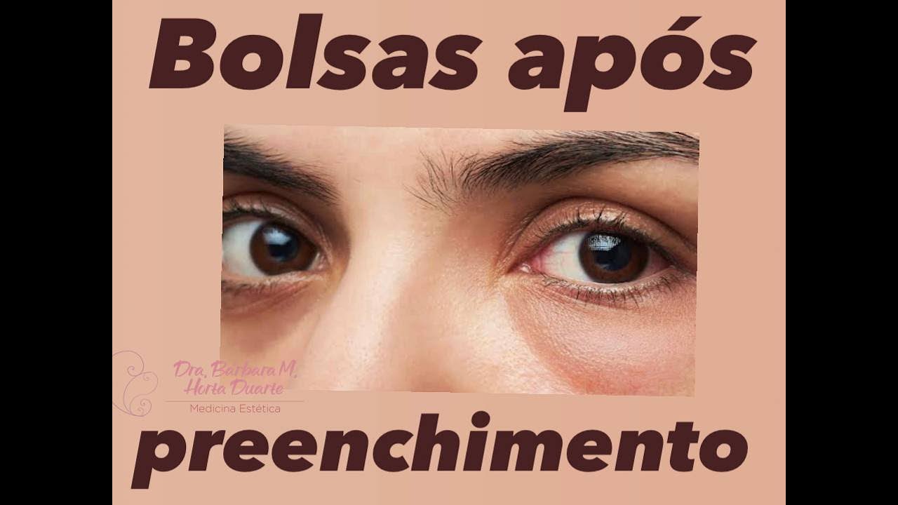 Bags under the eyes after fillers: know the possible causes