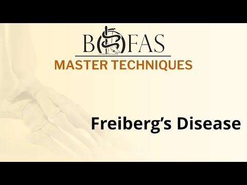 Freiberg's Disease - BOFAS Master Techniques