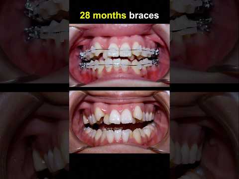 28 months braces transformation #braces #dentist #orthodontist #asmr