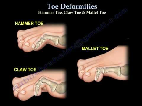 Mallet Toe - Foot & Ankle - Orthobullets
