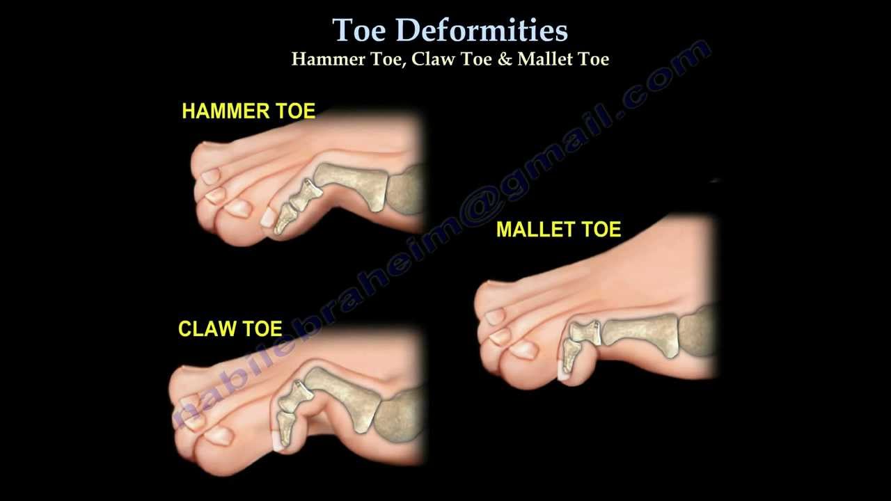 Toe Deformities Hammer, Claw & Mallet Toes - Everything You Need To Know - Dr. Nabil Ebraheim