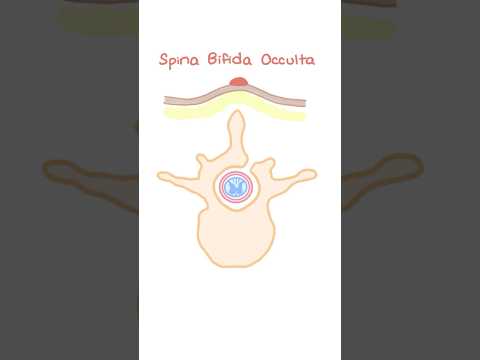 Types of Neural Tube Defects: Spina Bifida