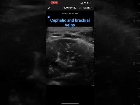Cephalic and brachial veins #anesthesiology #selfimprovement #ultrasound