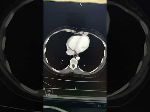 abddomen ct with contrast