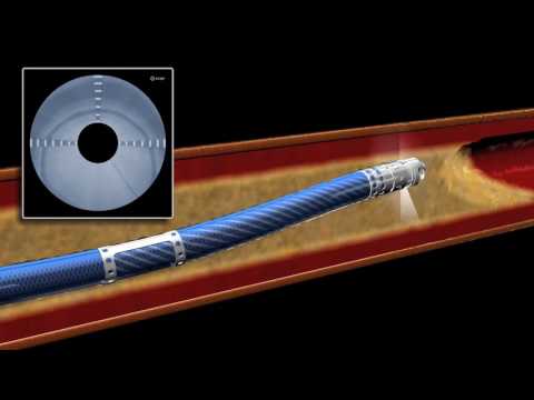 Ocelot Animation - Crossing a Peripheral Artery Disease CTO