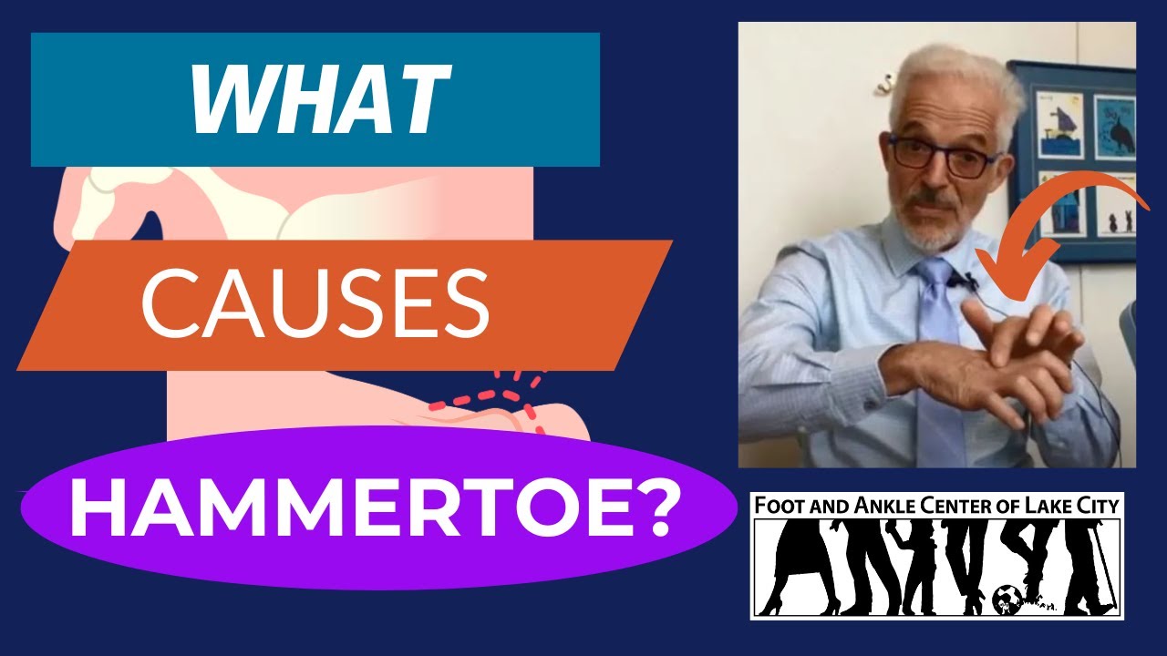 What Is a Hammertoe and What Causes It? | Foot and Ankle Center of Lake ...