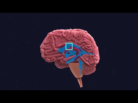Brain Bleeds in Babies: Posthemorrhagic Hydrocephalus